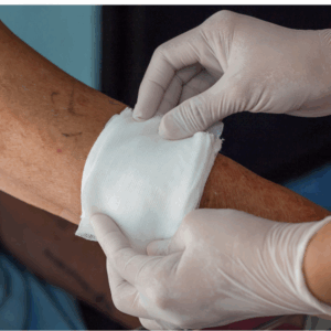 Pre-Ulcerative Callus: What are they and how do you prevent them